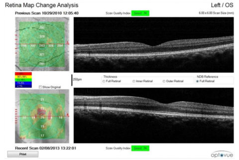 Eye-Tech Inc & Optovue | Opthalmology & Optometry Eye Diagnostic